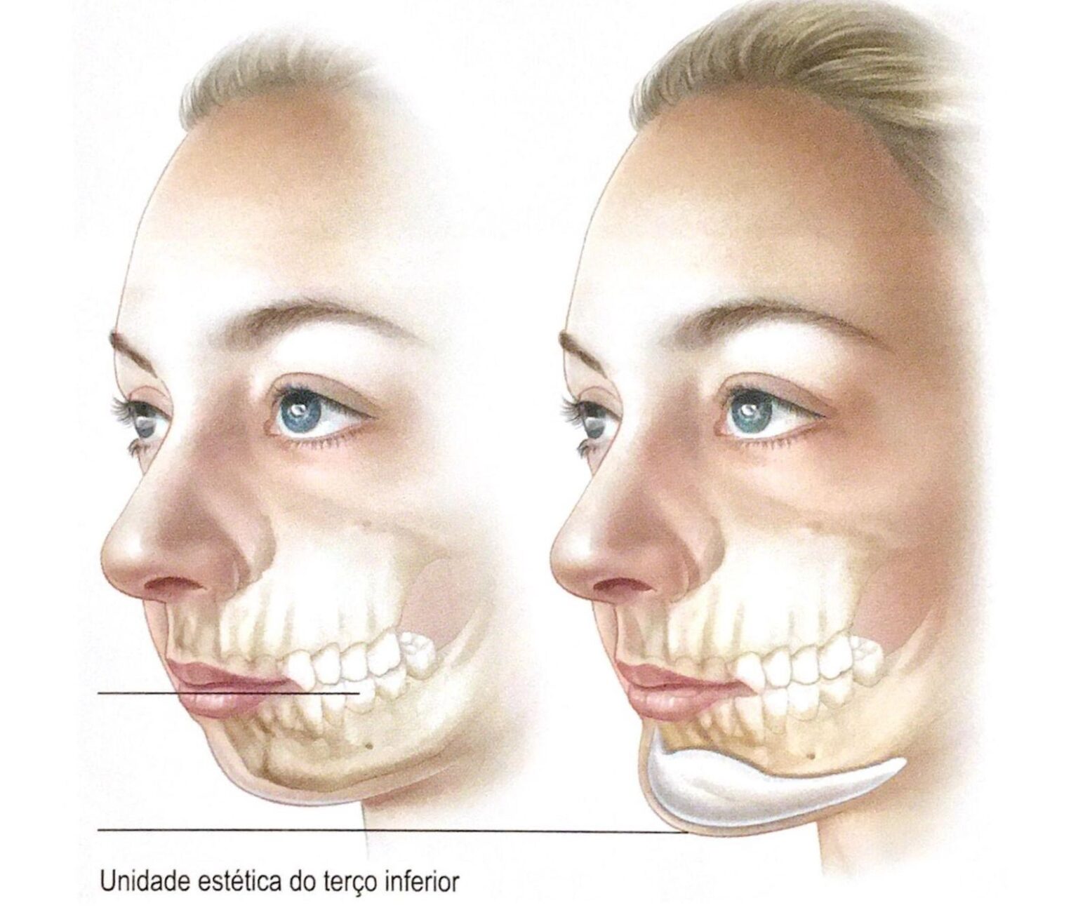 Cirurgia Plástica do Mento | Queixo: Mentoplastia São Paulo. Eliza Minami