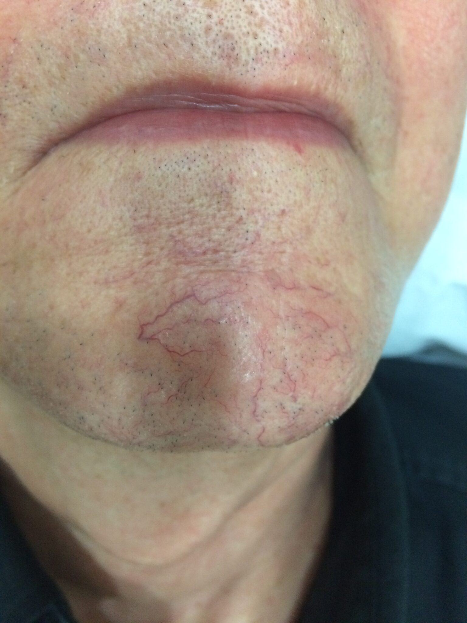 Laser Vascular em São Paulo Clínica Dra. Eliza Minami Cirurgia Plástica